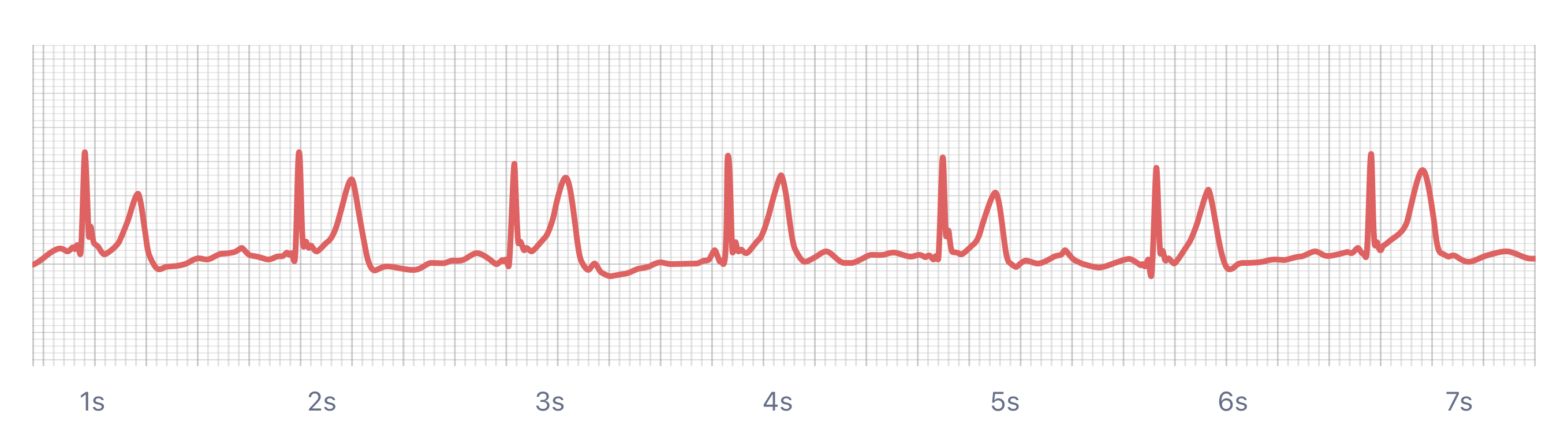 What Complete Heart Block Looks Like on Your Watch ECG | Qaly